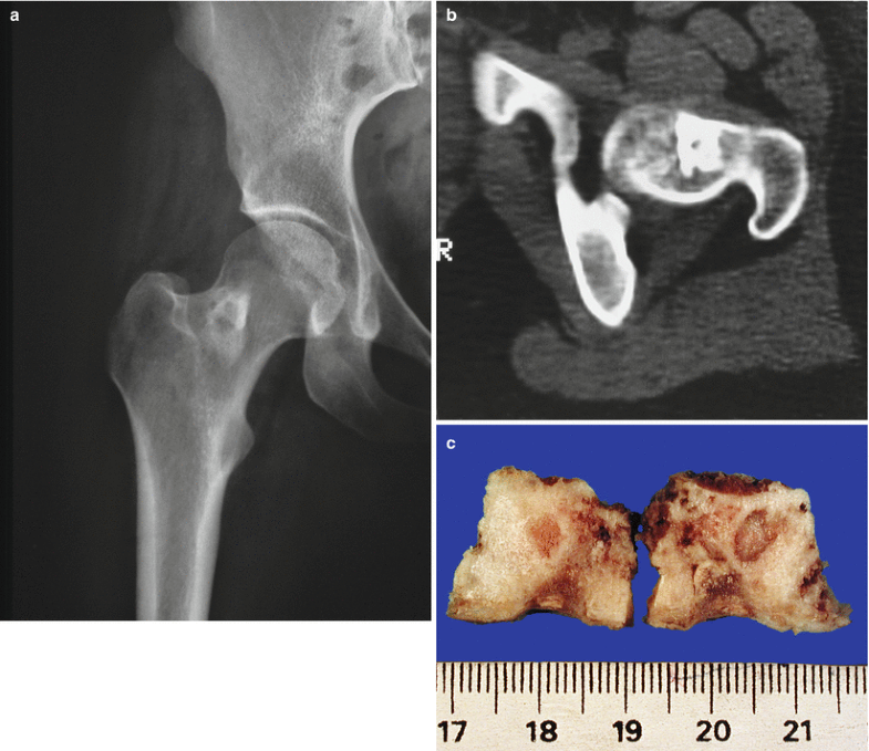 Osteoid Osteoma | SpringerLink