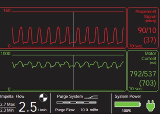 Advanced Hemodynamic Support | SpringerLink