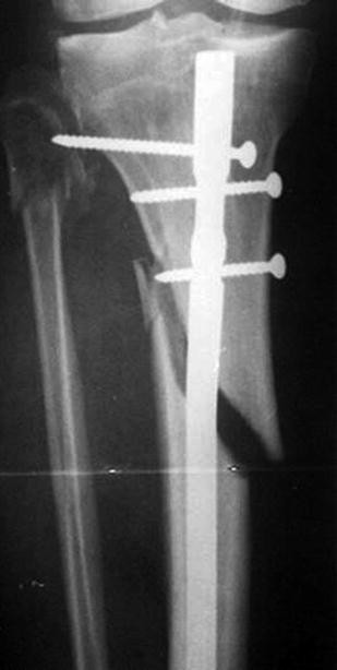 Complications of Intramedullary Nailing | SpringerLink