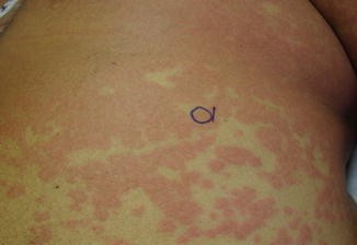 Morbilliform Drug Eruptions | SpringerLink