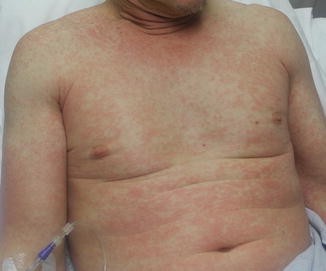 Morbilliform Drug Eruptions | SpringerLink