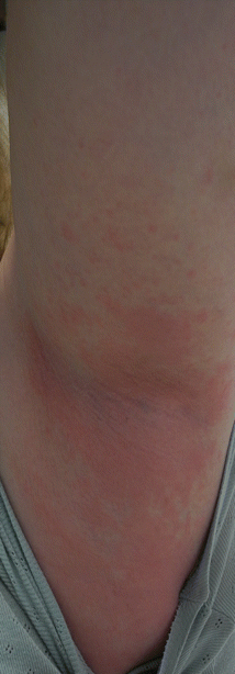 Morbilliform Drug Eruptions | SpringerLink