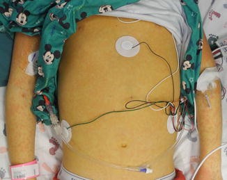 Morbilliform Drug Eruptions | SpringerLink