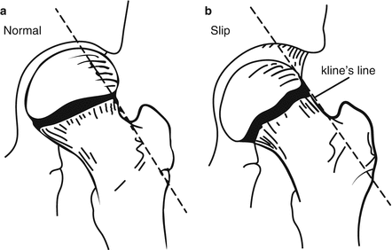 Slipped Capital Femoral Epiphysis | SpringerLink