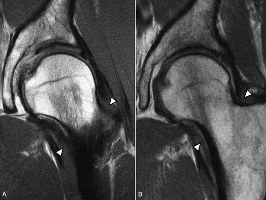 Magnetic Resonance Imaging of the Hip Labrum, Capsule, and Synovium ...