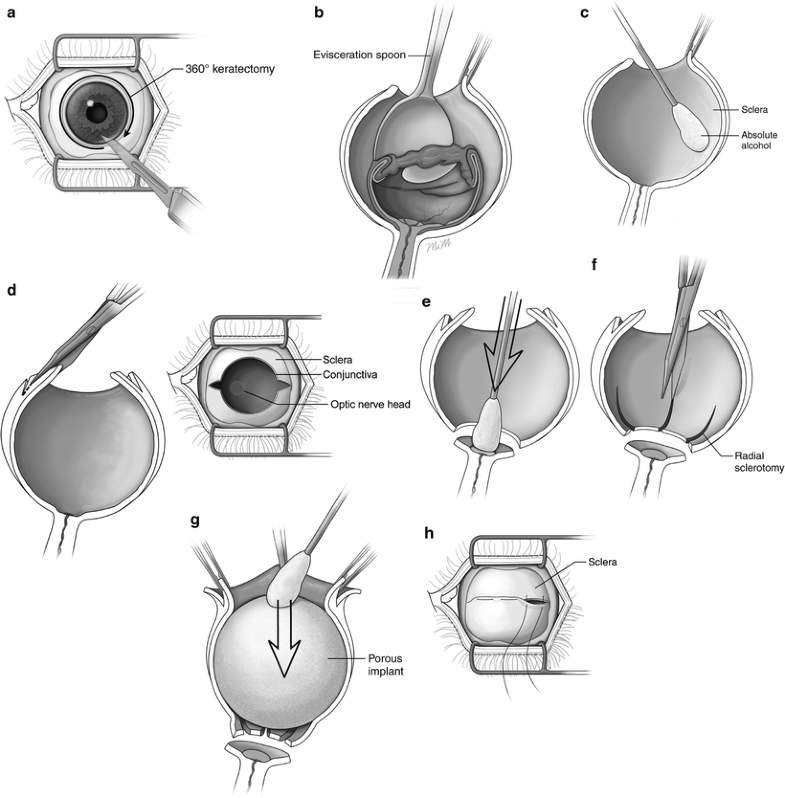 Enucleation, Evisceration, Secondary Orbital Implantation | SpringerLink
