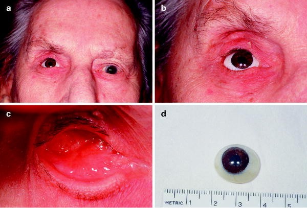 Evaluation and Management of the Anophthalmic Socket and Socket ...