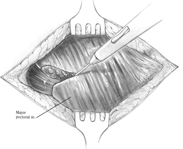 Esophagectomy: Right Thoracotomy and Laparotomy | SpringerLink