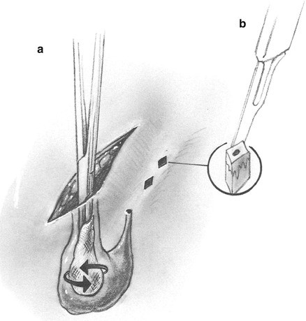 Operations for Pilonidal Disease | SpringerLink