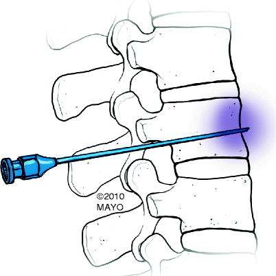 Thoracic and Lumbar Sympathetic Nerve Block and Neurolysis | SpringerLink