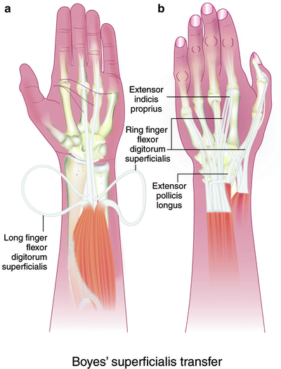 Secondary Procedures for Failed Tendon Transfers | SpringerLink