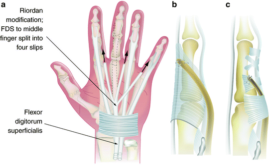 Secondary Procedures for Failed Tendon Transfers | SpringerLink