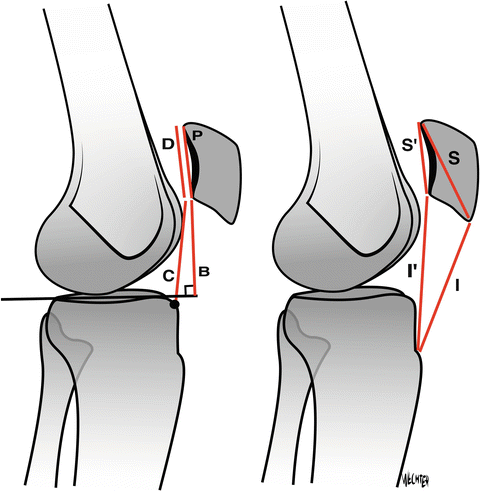Lateral Patella Dislocations: History, Physical Exam, and Imaging ...
