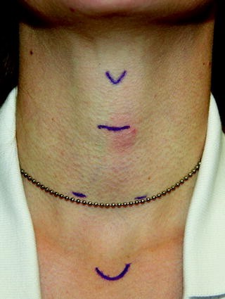 Transtracheal Oxygen Catheter Placement and Management | SpringerLink