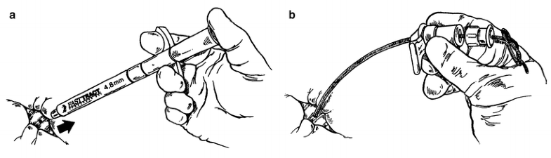 Transtracheal Oxygen Catheter Placement and Management | SpringerLink