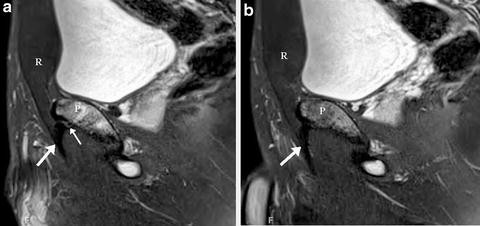 Athletic Groin Pain and Sports Hernia | SpringerLink