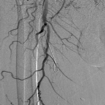 Femoral Artery: CFA, SFA, Profunda Femoris Artery Lesions | SpringerLink