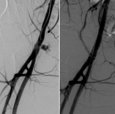 Femoral Artery: CFA, SFA, Profunda Femoris Artery Lesions | SpringerLink