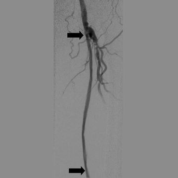 Femoral Artery: CFA, SFA, Profunda Femoris Artery Lesions | SpringerLink