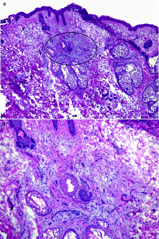 Infiltrative Basal Cell Carcinoma | SpringerLink