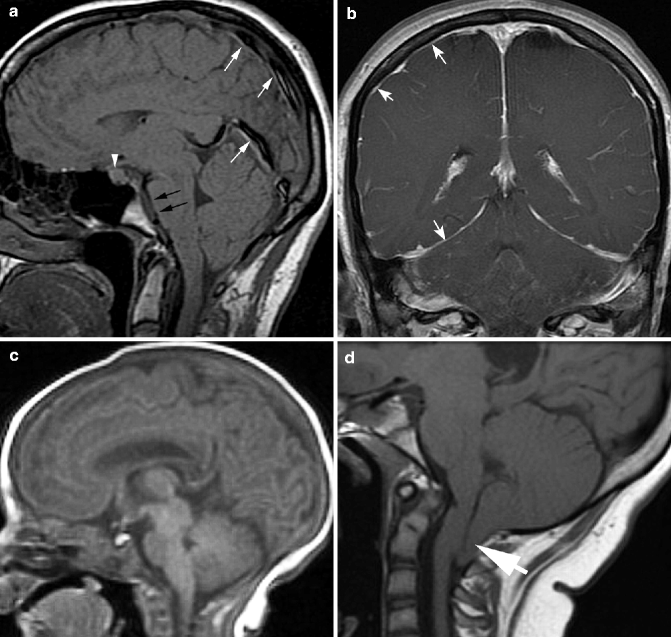 Radiology of the Chiari Malformations | SpringerLink
