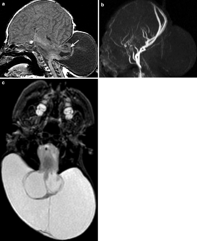 Radiology of the Chiari Malformations | SpringerLink