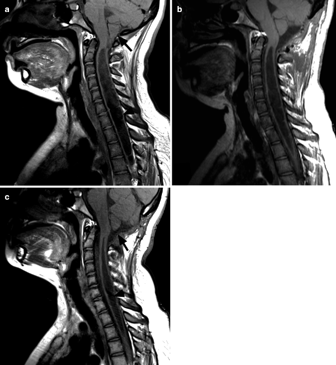 Treatment of the Adult Chiari I Malformation | SpringerLink