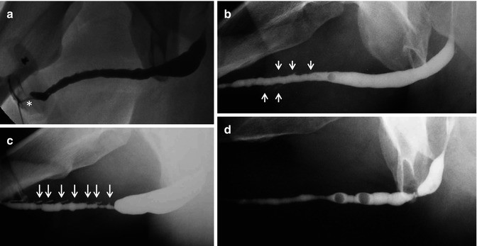 Lichen Sclerosus | SpringerLink