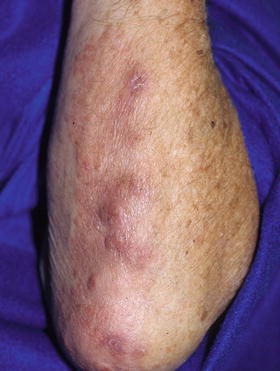 Nodules in Rheumatoid Arthritis | SpringerLink