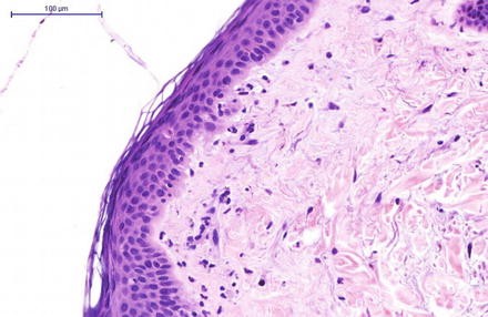 Skin Manifestation in Dermatomyositis | SpringerLink