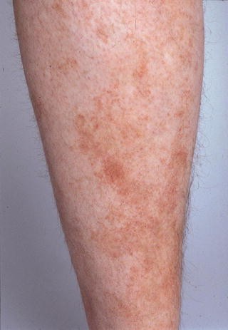 Purpura | SpringerLink