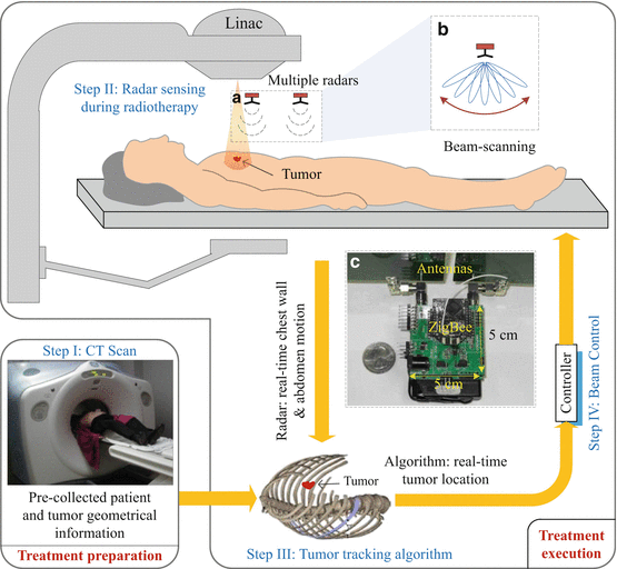 Doppler Radar Noncontact Vital Sign Monitoring | SpringerLink