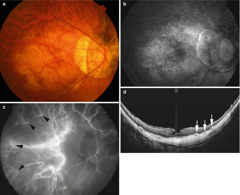Myopic Chorioretinal Atrophy | SpringerLink