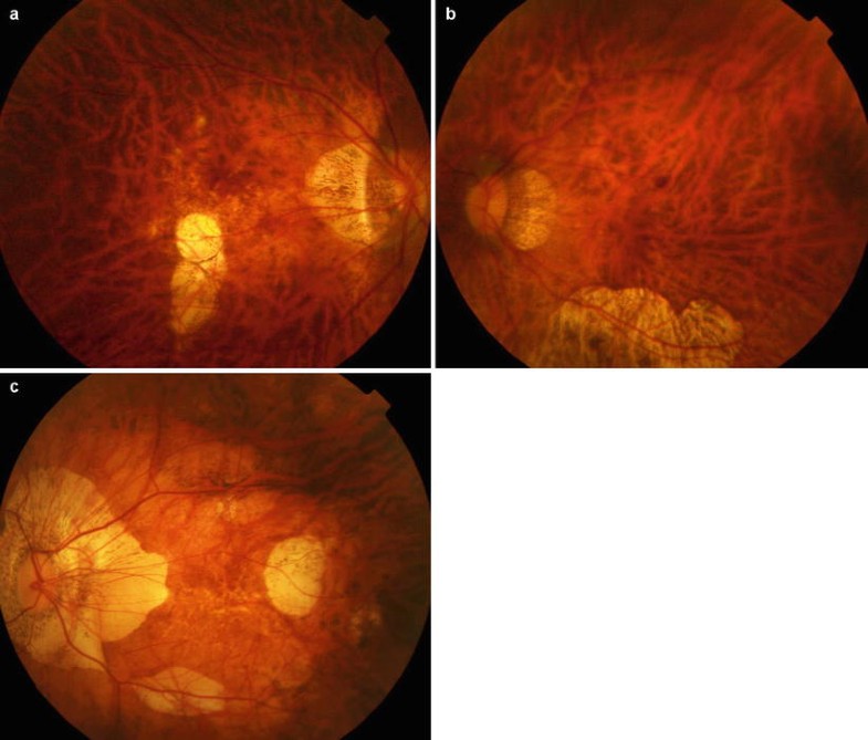Myopic Chorioretinal Atrophy | SpringerLink