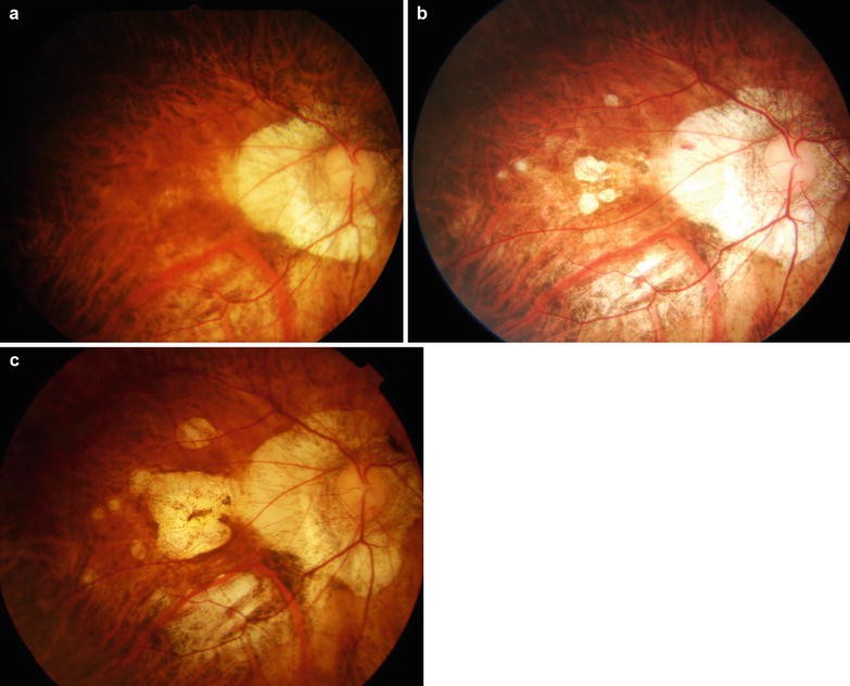 Myopic Chorioretinal Atrophy | SpringerLink