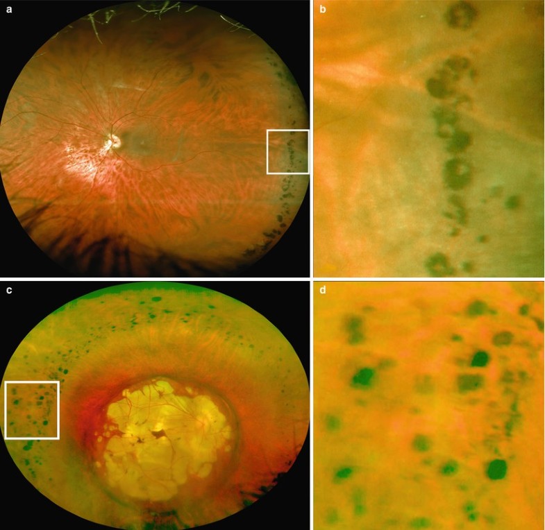Peripheral Retinal Abnormalities | SpringerLink