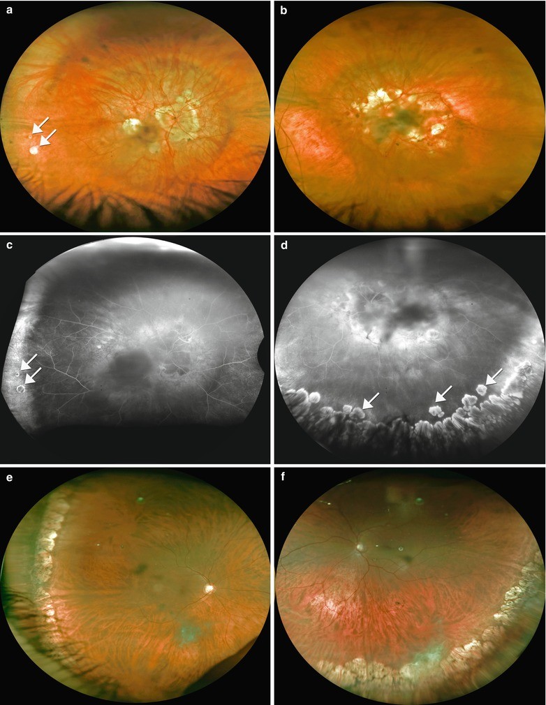 Peripheral Retinal Abnormalities | SpringerLink