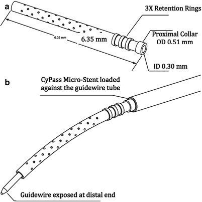 The CyPass Suprachoroidal Micro-Stent | SpringerLink