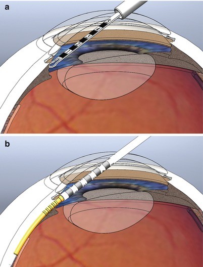 The CyPass Suprachoroidal Micro-Stent | SpringerLink