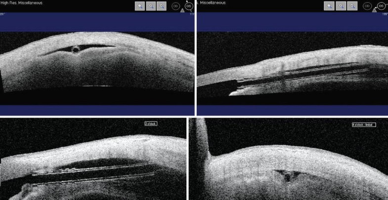 The CyPass Suprachoroidal Micro-Stent | SpringerLink