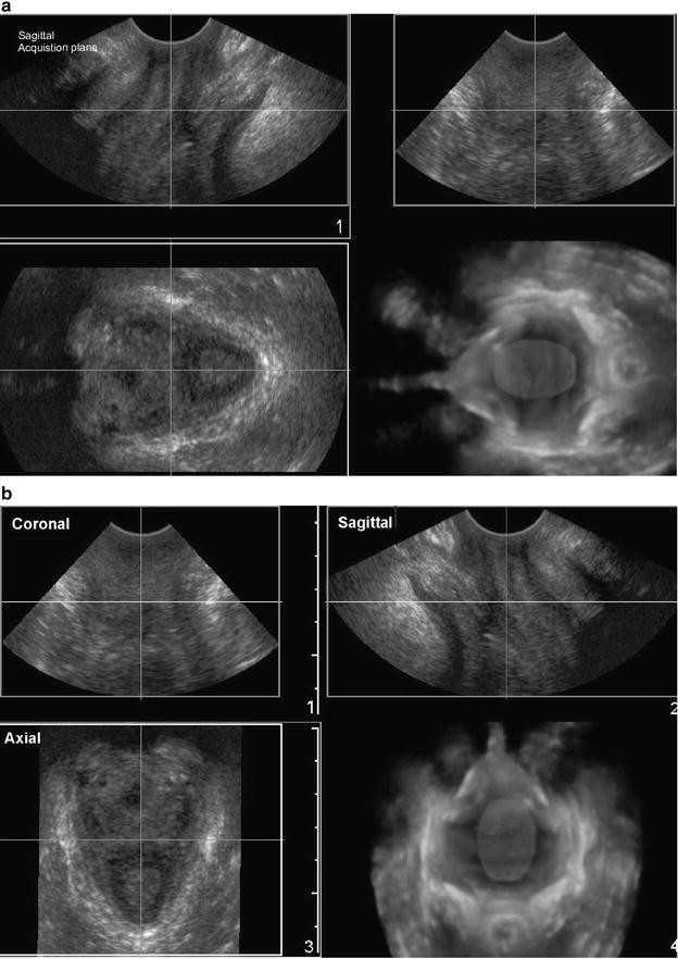 Instrumentation and Techniques for Translabial and Transperineal Pelvic ...