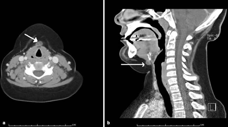 Thyroglossal Duct Cysts | SpringerLink