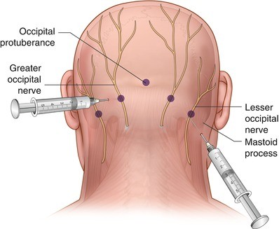 Occipital Nerve Blocks | SpringerLink