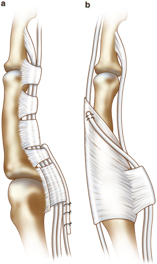 Camptodactyly and Clinodactyly | SpringerLink