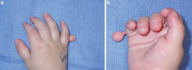 Ulnar Polydactyly and Ulnar Dimelia | SpringerLink
