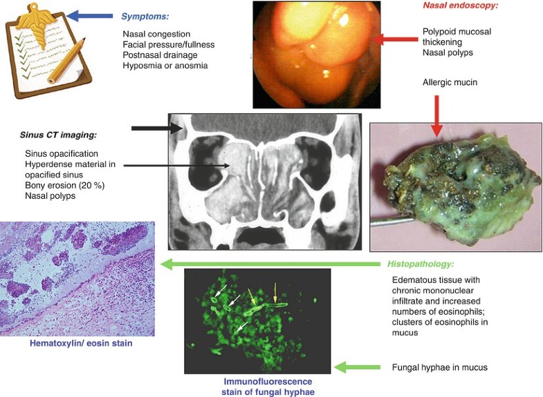 Diagnosis and Classification of Chronic Rhinosinusitis with and Without ...