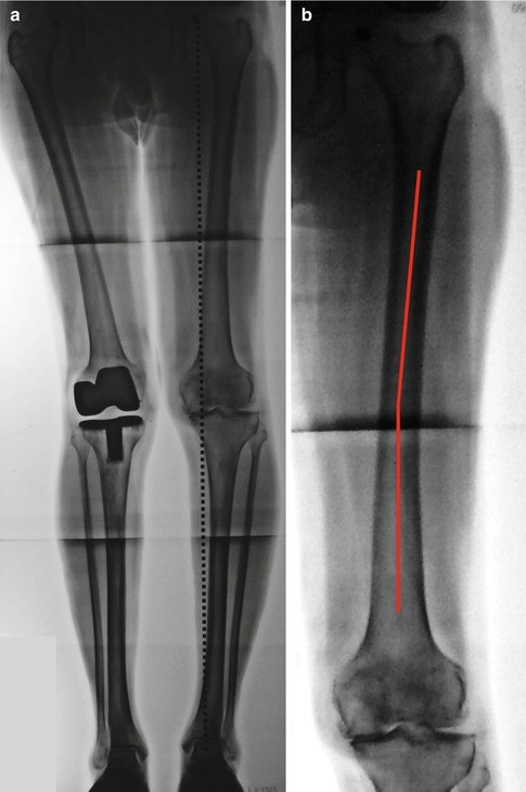 Varus Deformity | SpringerLink