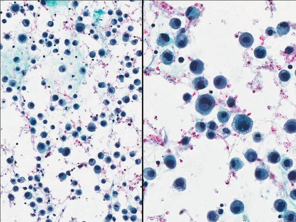Serous Fluid Cytopathology | SpringerLink