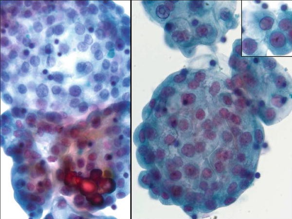 Serous Fluid Cytopathology | SpringerLink
