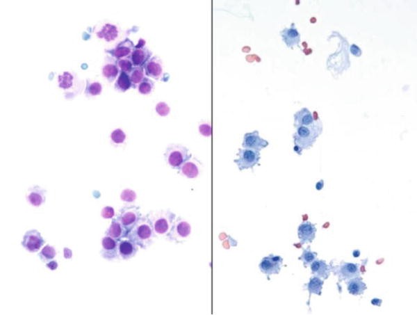 Cerebrospinal Fluid (CSF) Cytology | SpringerLink